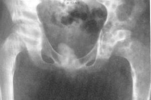 Legg-Calvé-Perthes Disease (LCPD) | Team Bone