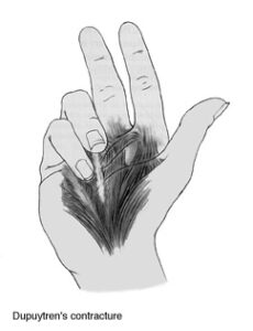 Dupuytren’s Contracture - Team Bone