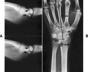 Common Fractures of Carpal Bones - Team Bone